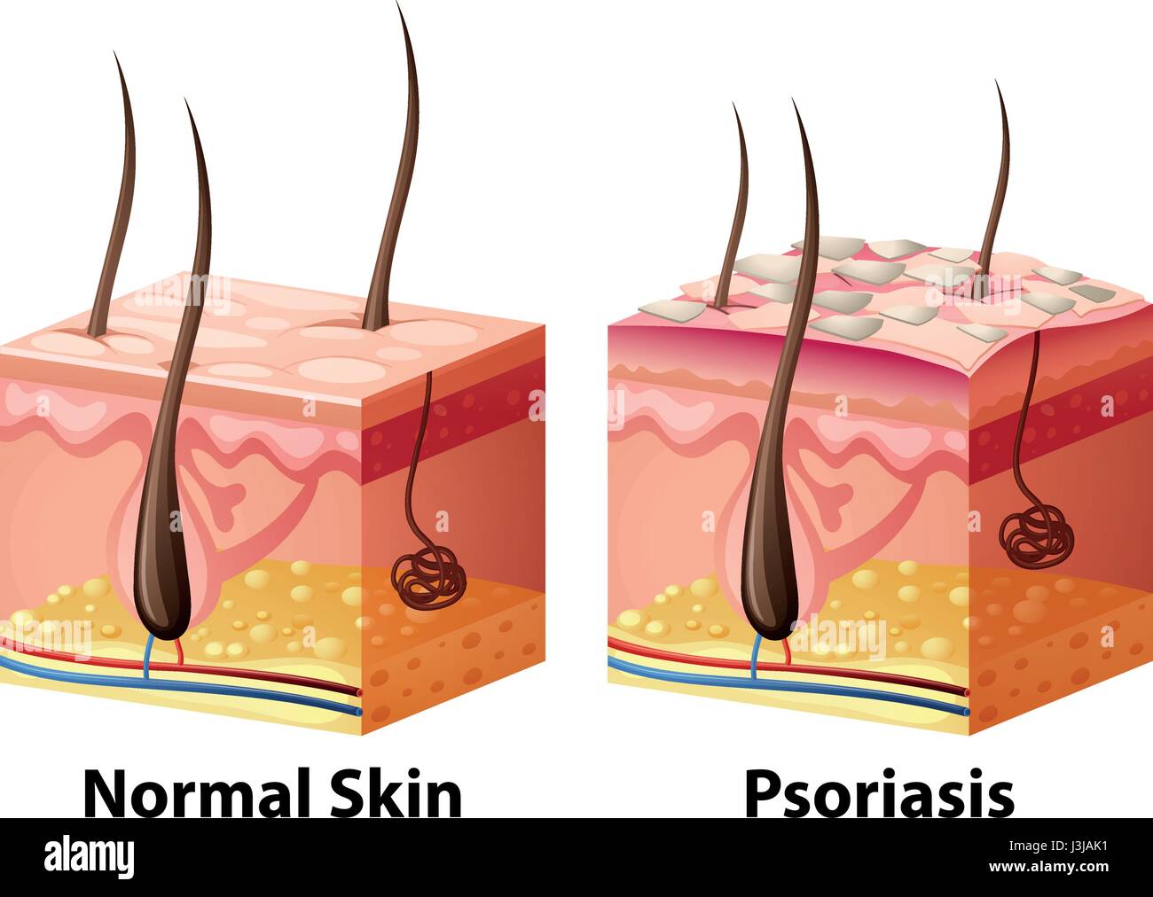 Schéma de la peau humaine normale et le psoriasis avec illustration ...