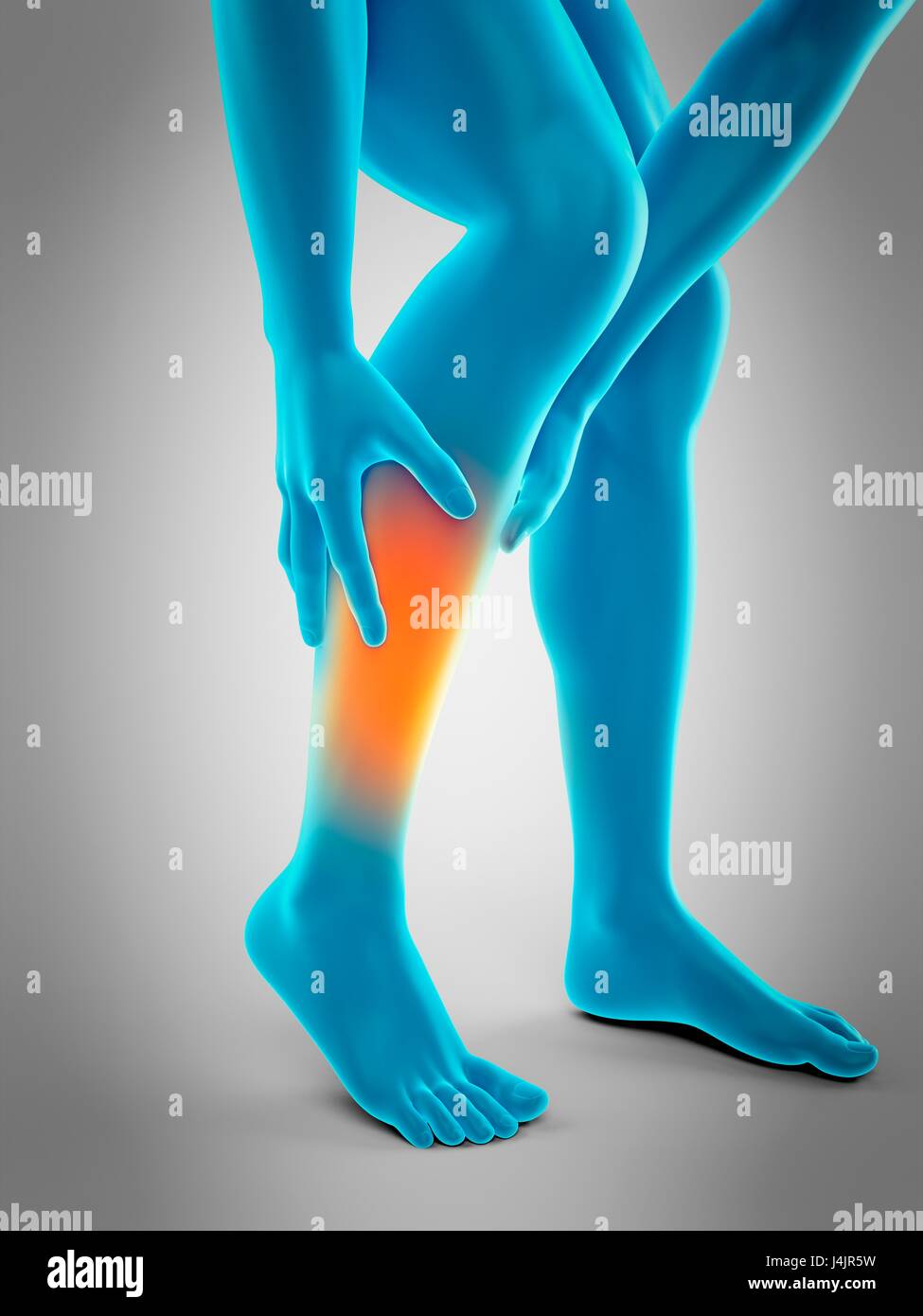 Douleur au mollet humain Banque de photographies et d’images à haute ...