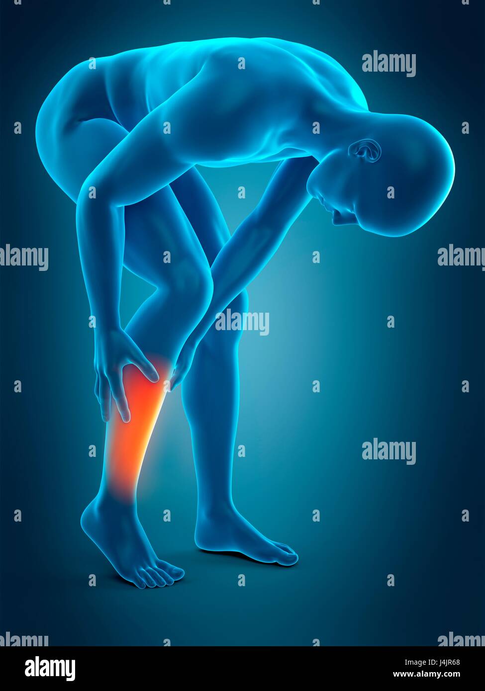 Douleur au mollet humain Banque de photographies et d’images à haute ...