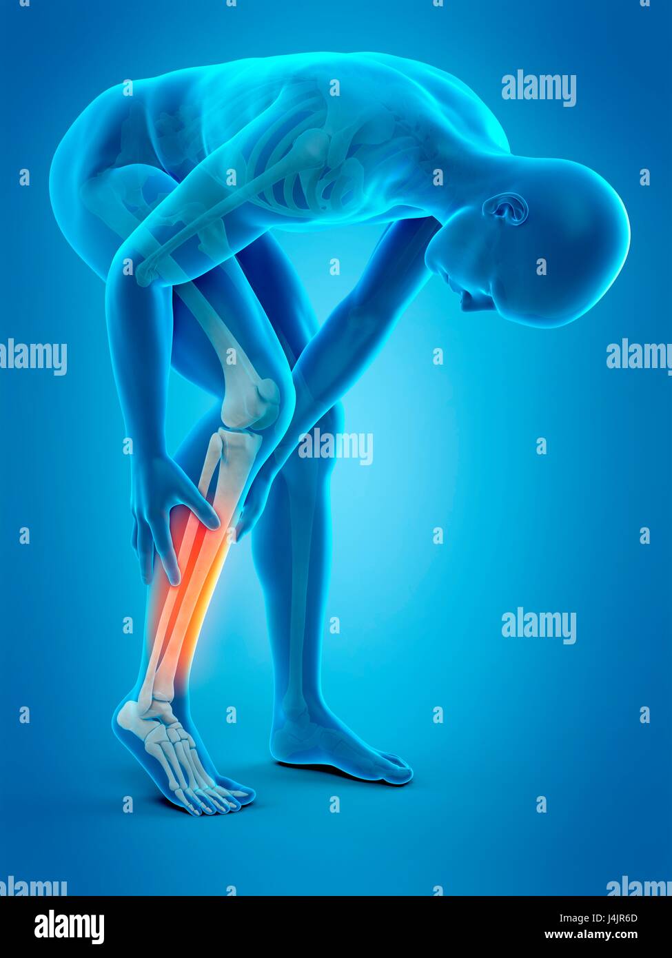 Douleur musculaire au mollet Banque de photographies et d’images à ...