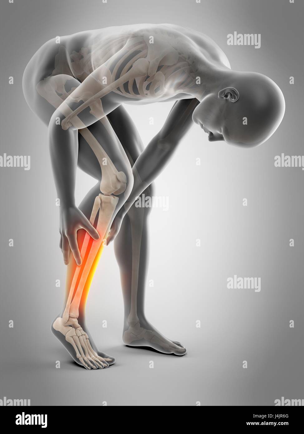 Douleur musculaire au mollet Banque de photographies et d’images à ...