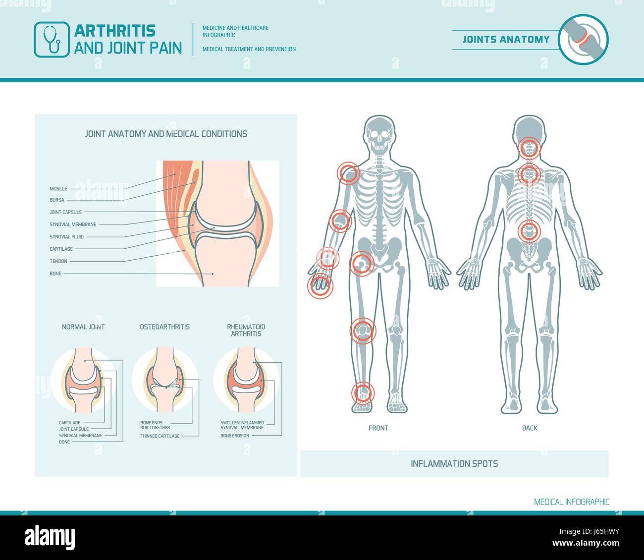 L'arthrite rhumatoïde, l'arthrose et les douleurs articulaires l ...