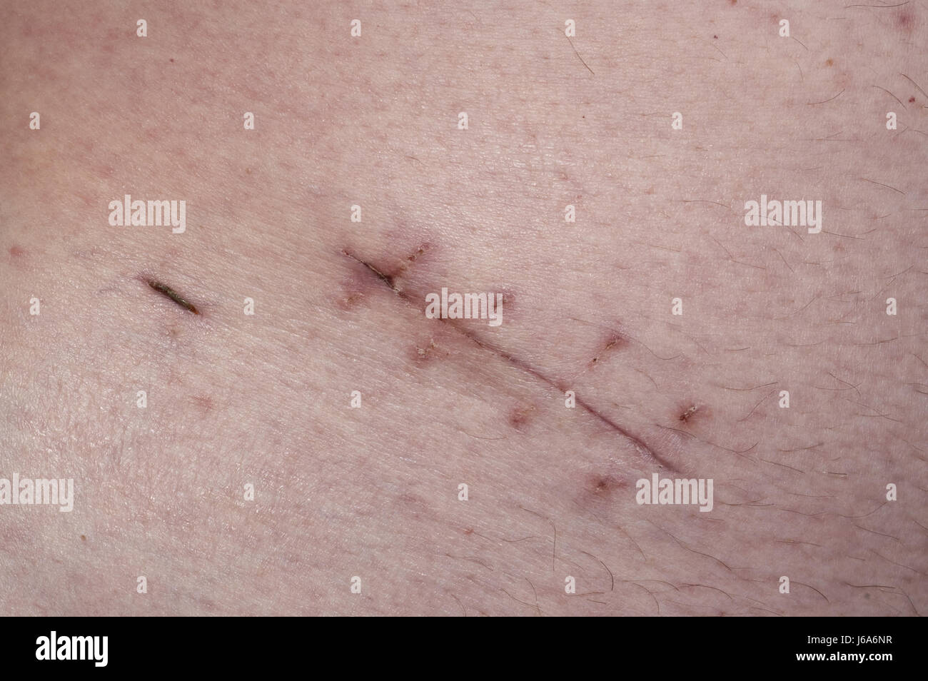 Appendix scar Banque de photographies et d’images à haute résolution ...