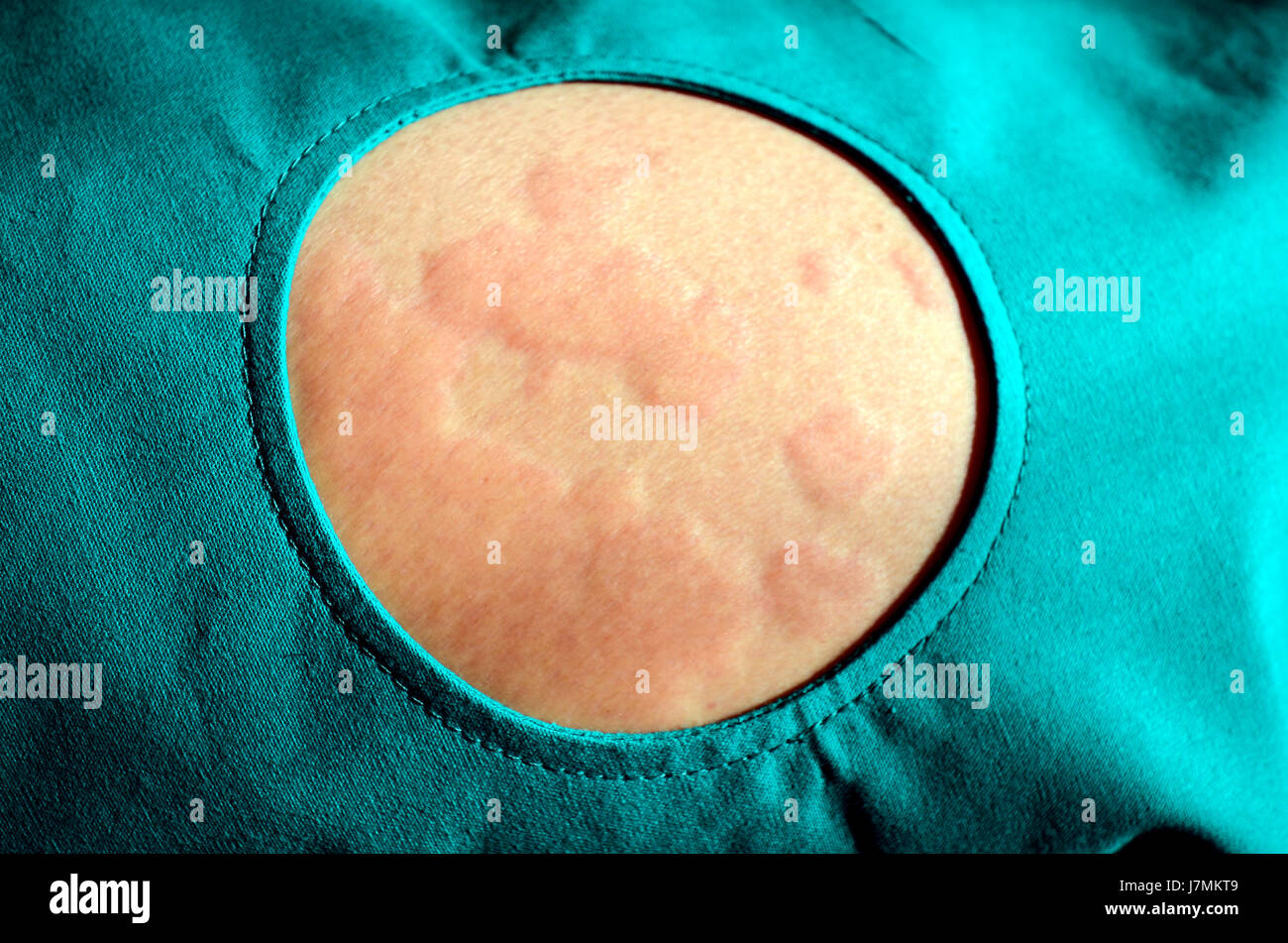 Une éruption cutanée, urticaire, réaction allergique de la peau Photo ...