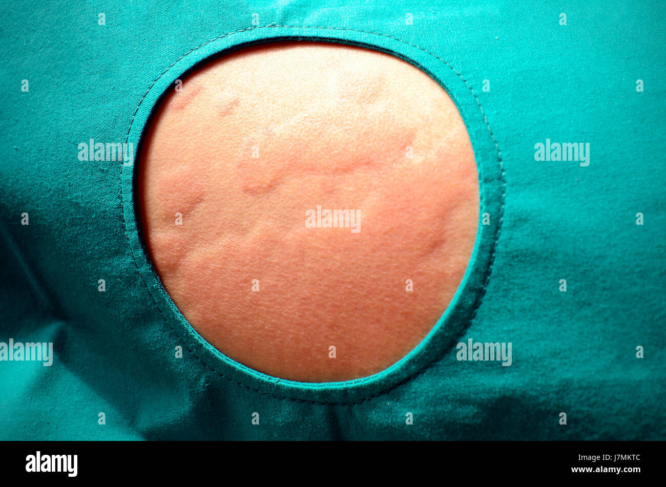 Une éruption cutanée, urticaire, réaction allergique de la peau Photo ...