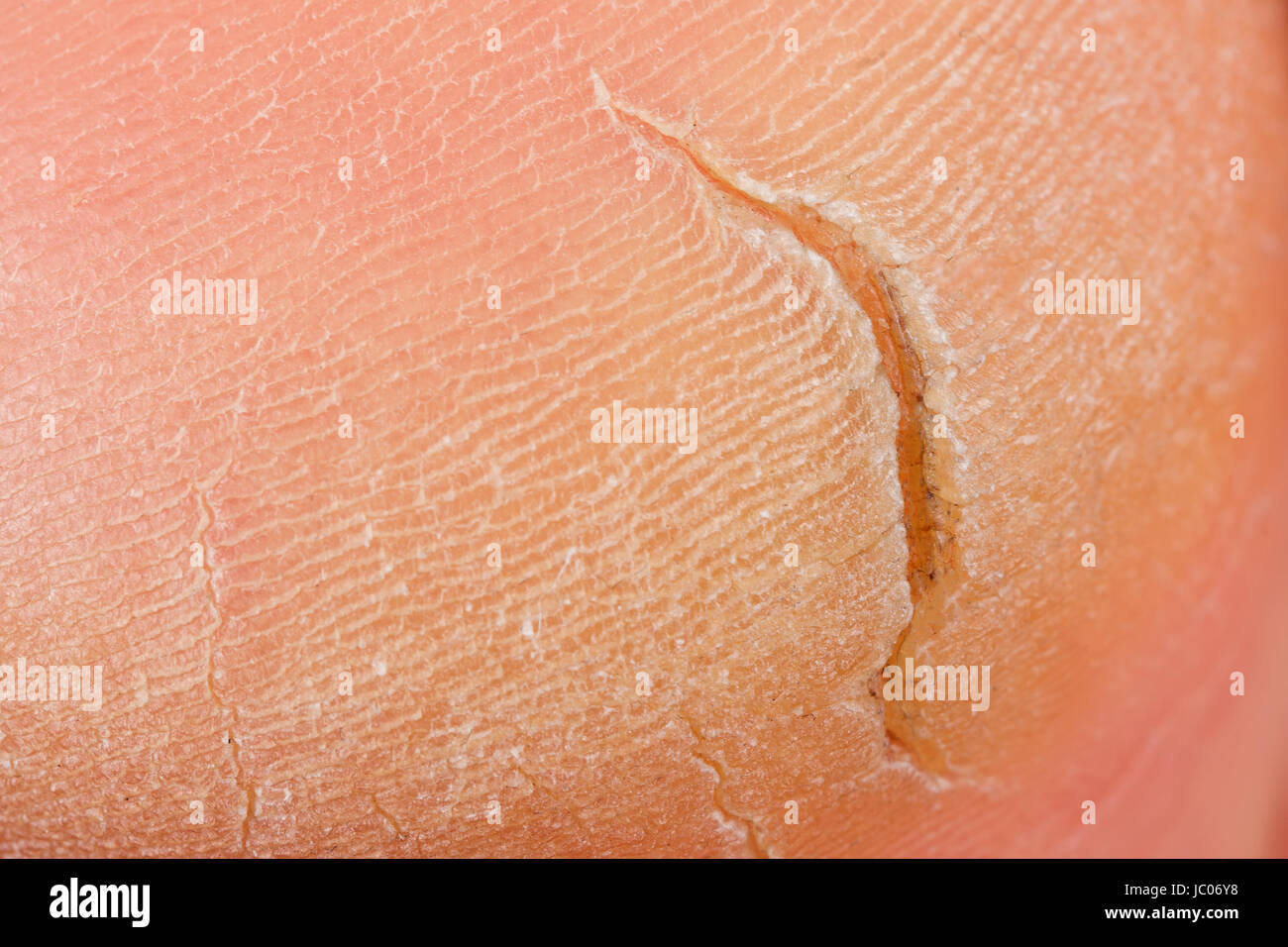 Peau de psoriasis jambe Banque de photographies et d’images à haute ...