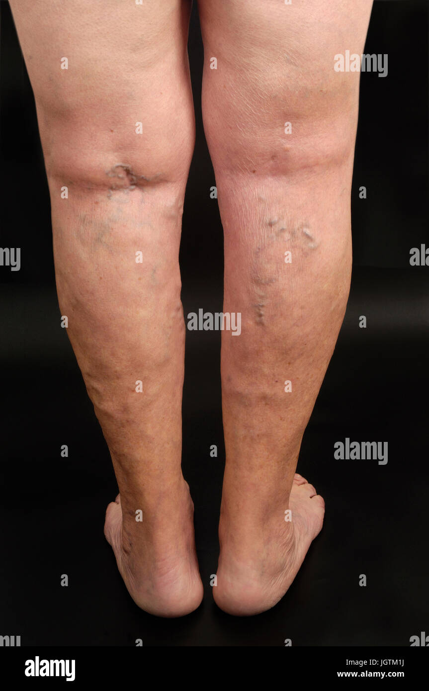 Varicose veins feet Banque de photographies et d’images à haute ...