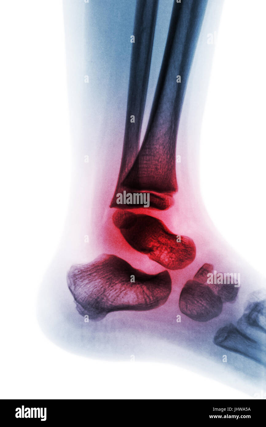 L'arthrite de cheville . X-ray de la cheville de l'enfant et enflamment ...