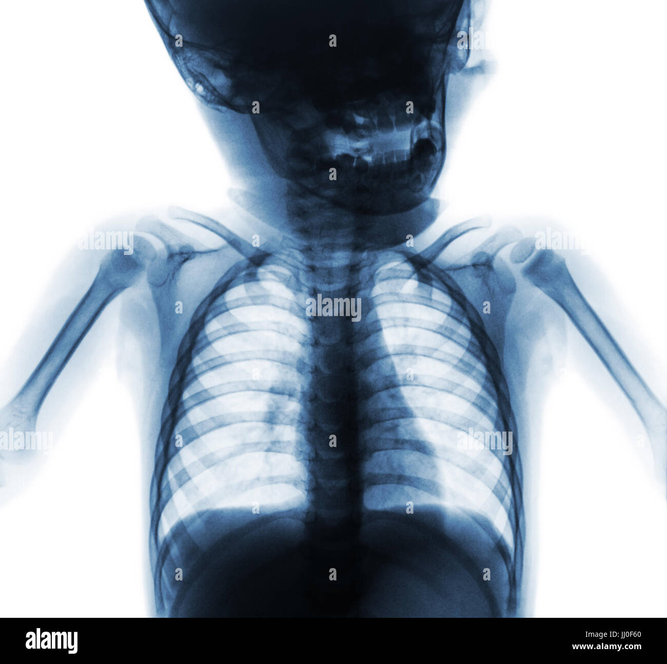 Film x-ray poitrine normale de bébé . La moitié supérieure du corps ...