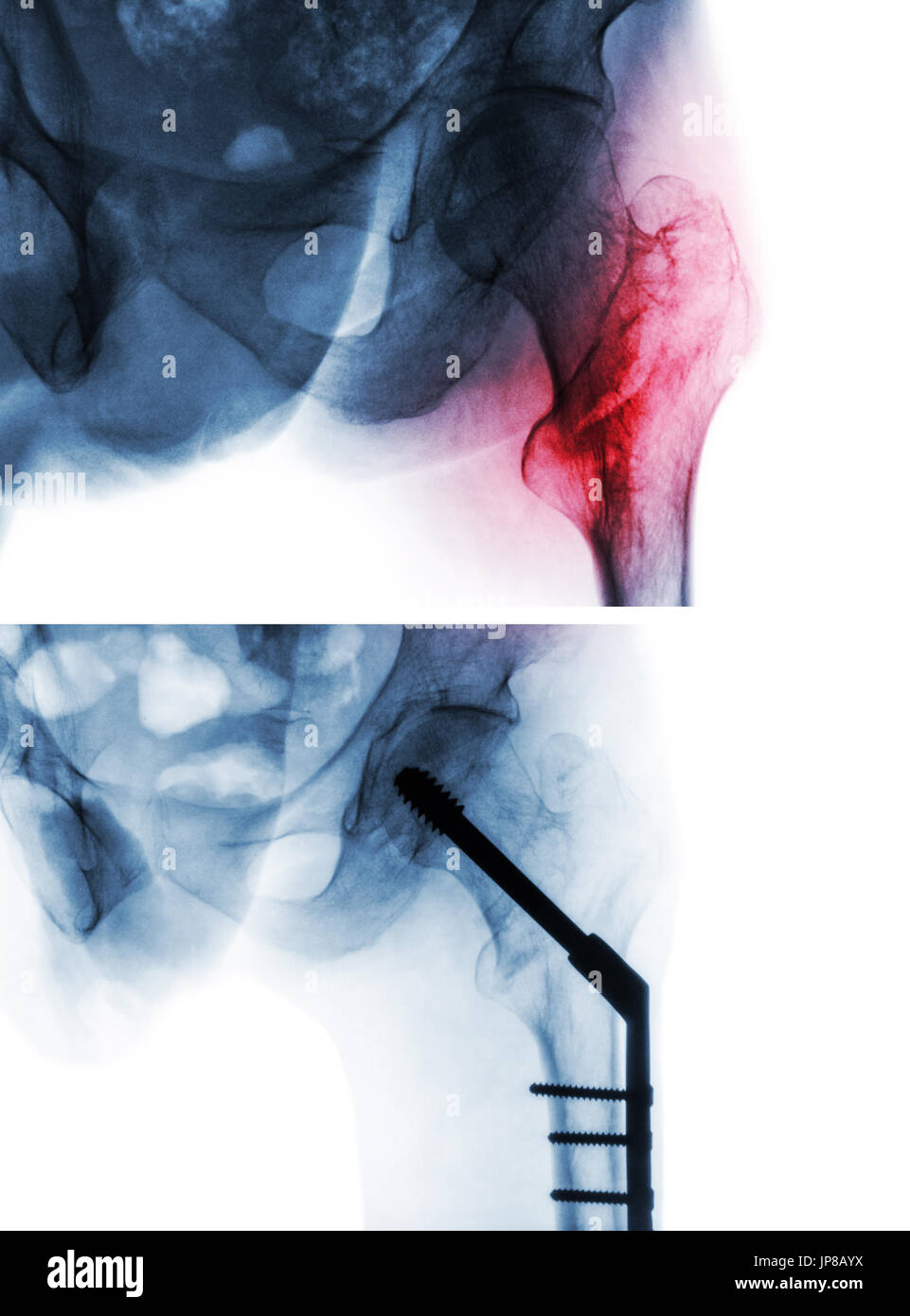 Intertrochanteric fémur fracture ( os de cuisse ). X-ray de hanche et ...