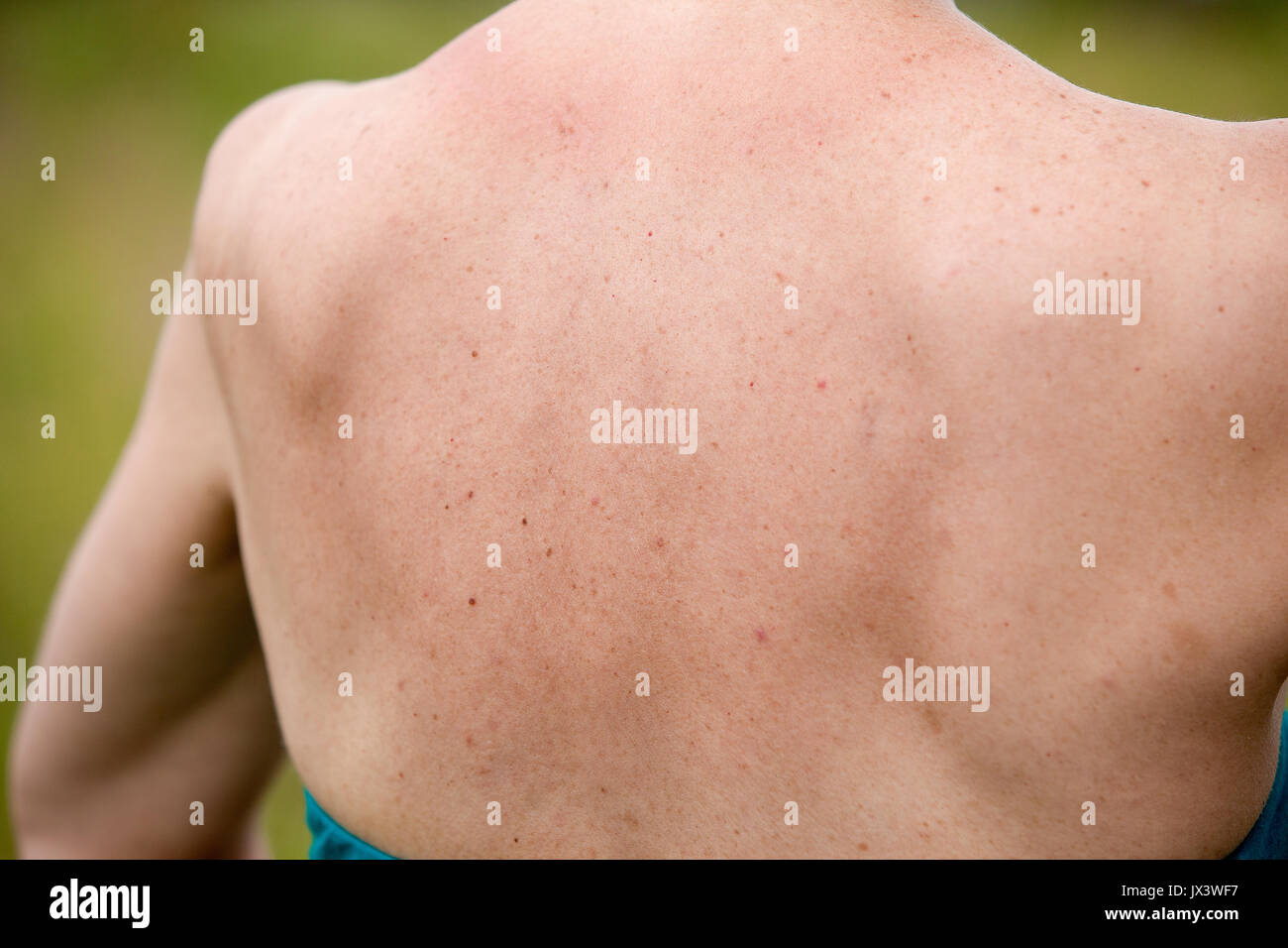 Pigmentation de la peau Banque de photographies et d’images à haute ...
