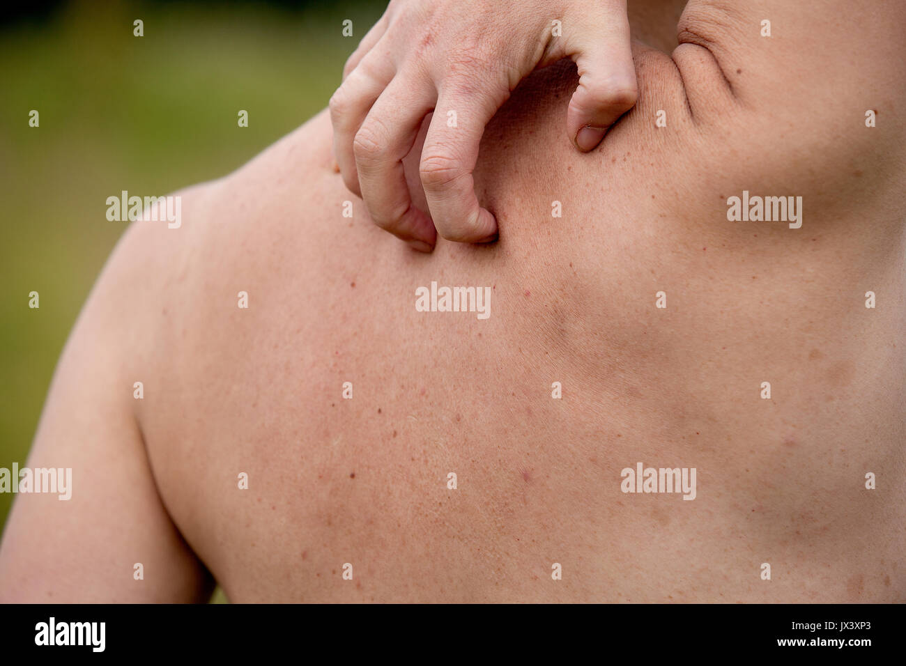 Pigmentation de la peau Banque de photographies et d’images à haute ...