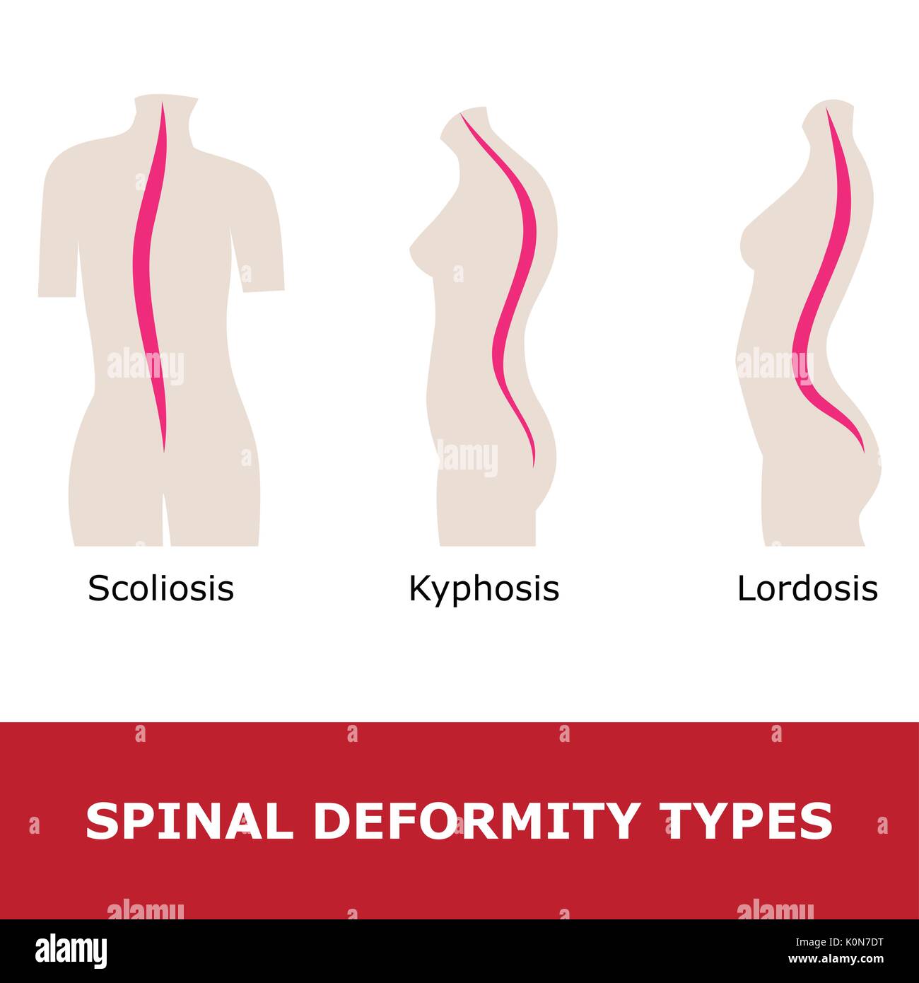 Posture scoliose lordose Banque de photographies et d’images à haute ...