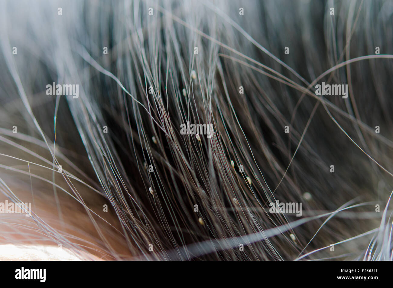 Head lice egg hair Banque de photographies et d’images à haute ...