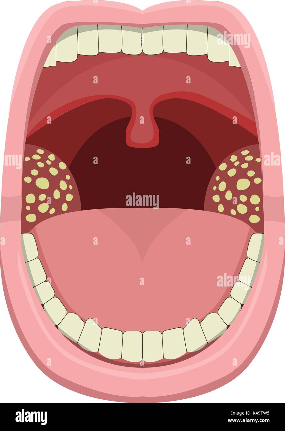 L'AMYGDALITE enflammée dans le vector design Image Vectorielle Stock ...