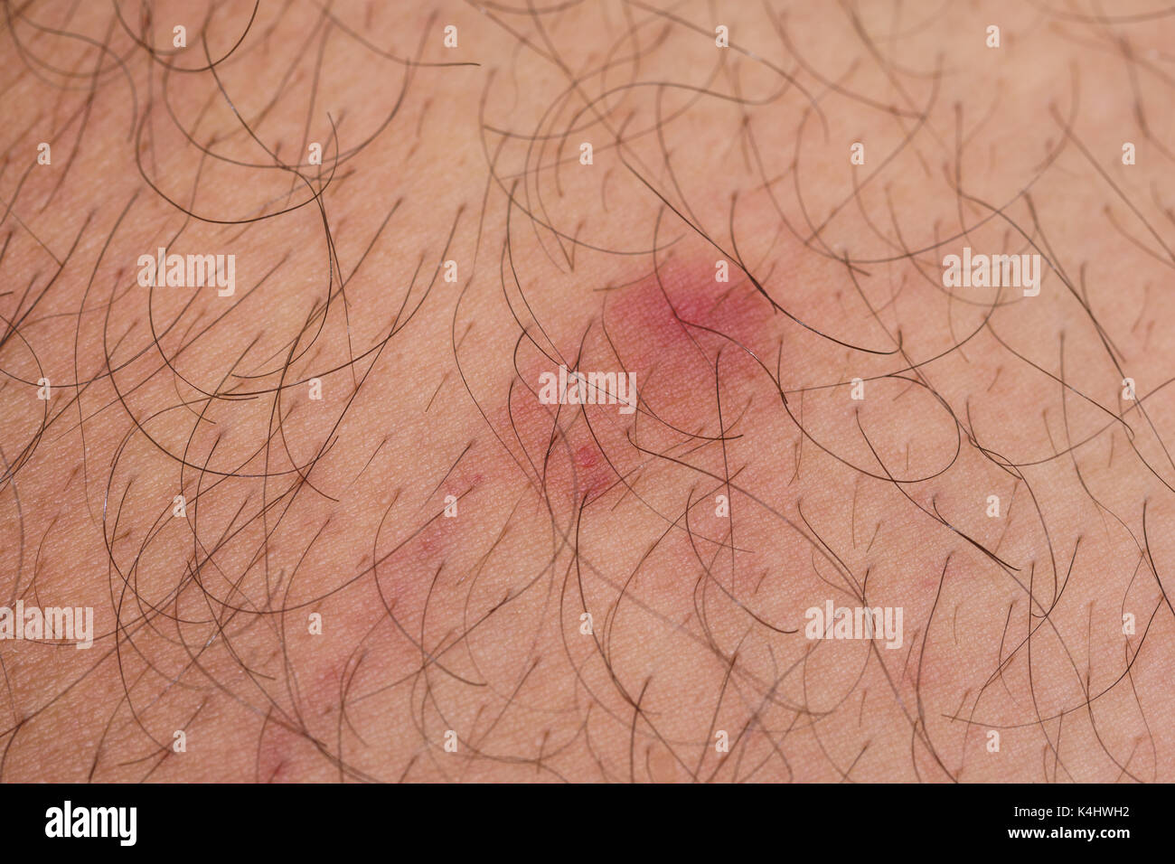 Rougeur démangeaison Banque de photographies et d’images à haute ...