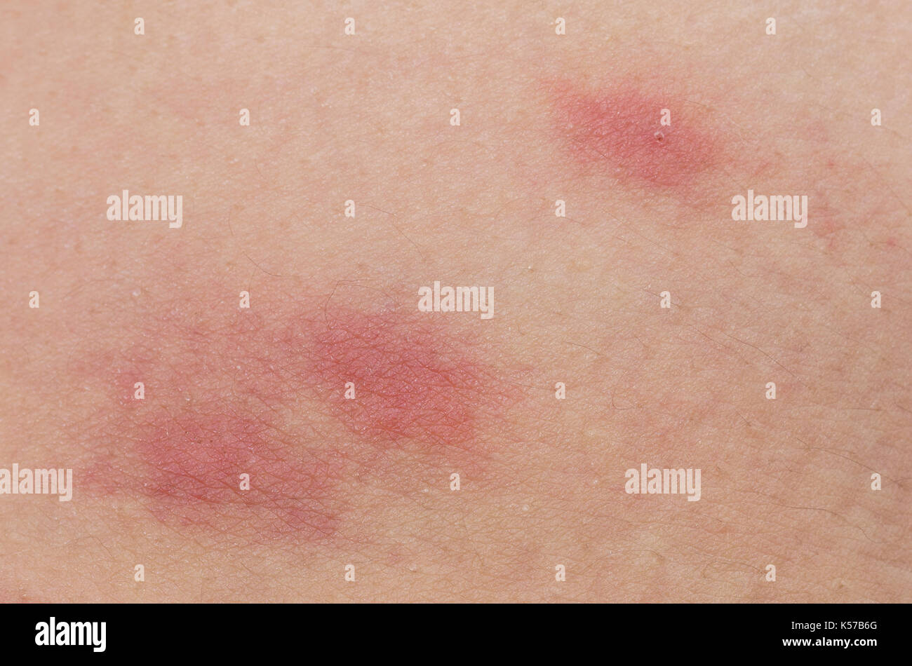 Libre de piqûres de puces Photo Stock - Alamy