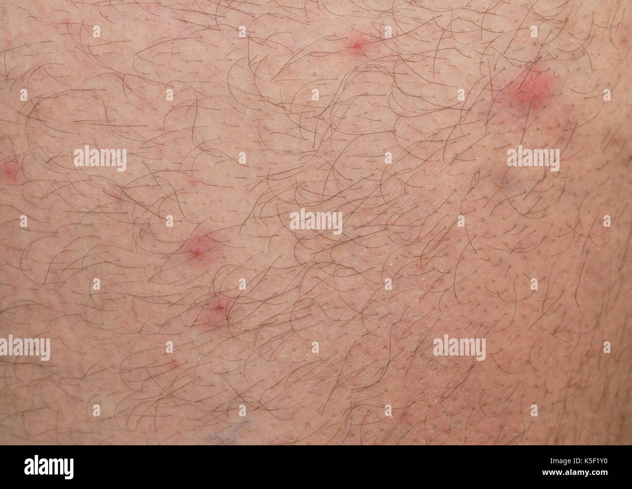 Rougeur démangeaison Banque de photographies et d’images à haute ...