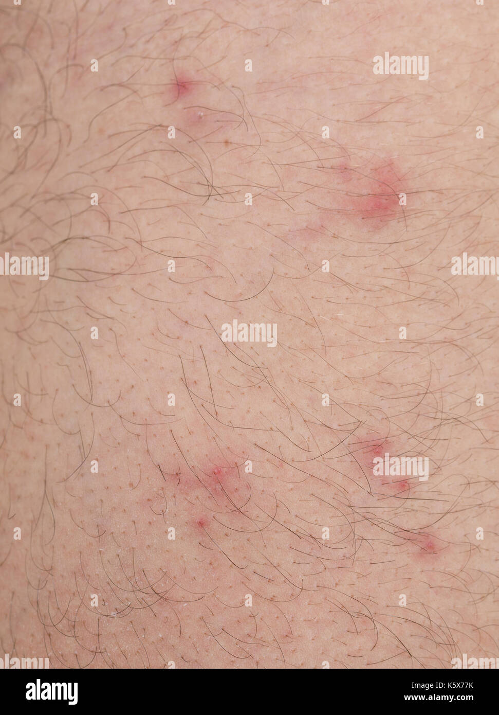 Piqûre de puce Banque de photographies et d’images à haute résolution ...