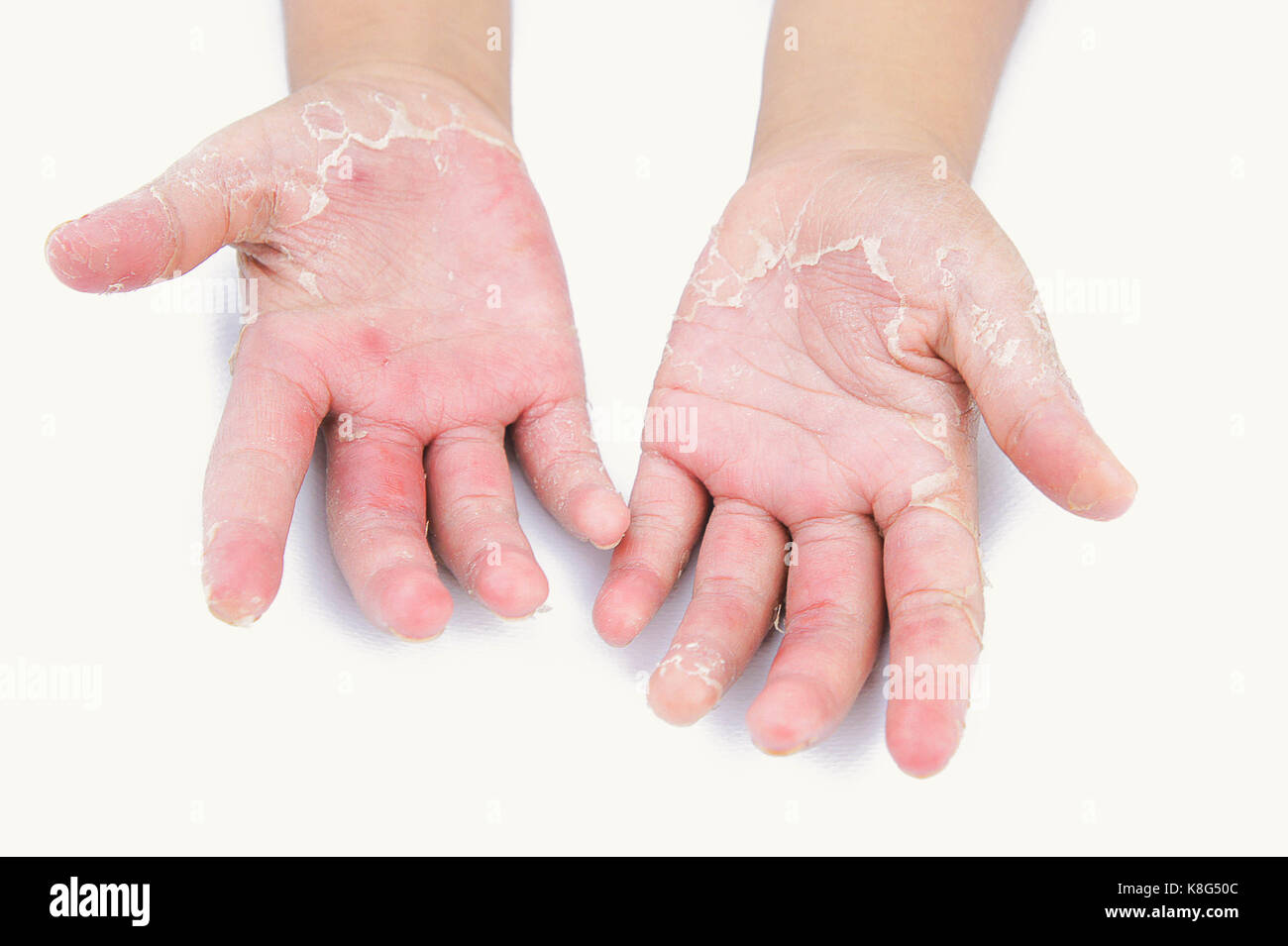 Infection De La Peau Banque d'image et photos - Alamy