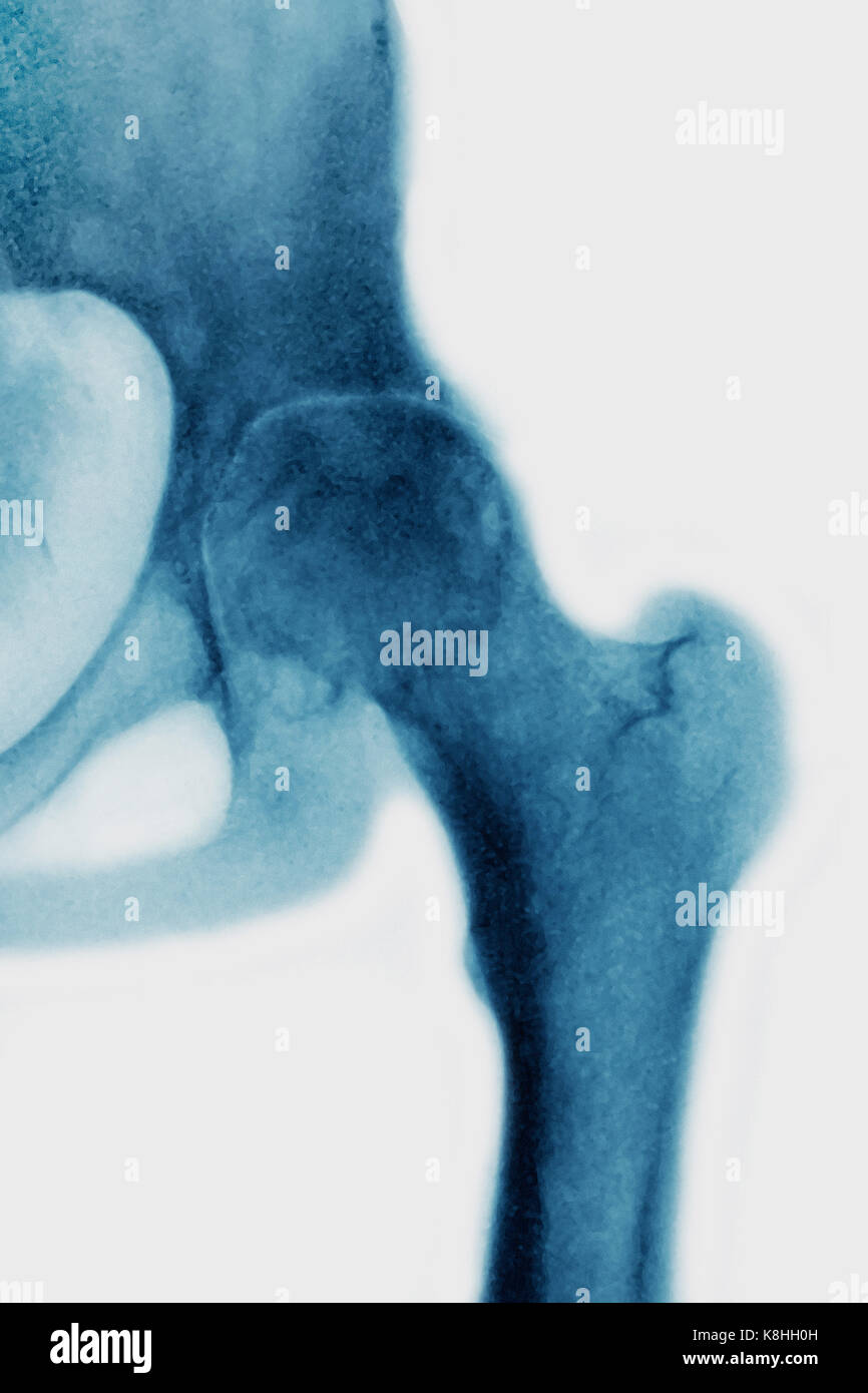 Arthrose hanche Banque de photographies et d’images à haute résolution ...