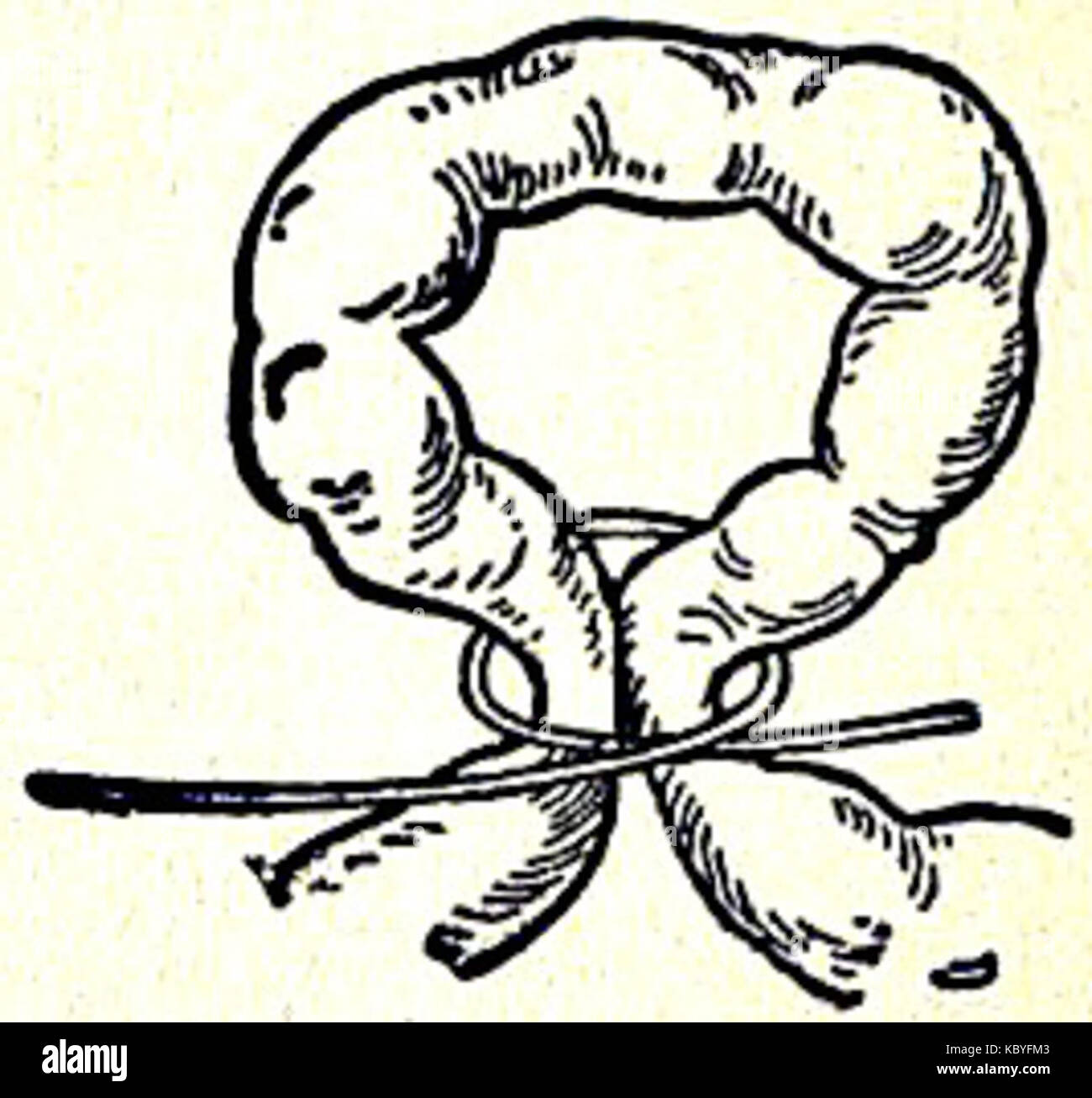 Une occlusion intestinale Banque de photographies et d’images à haute ...