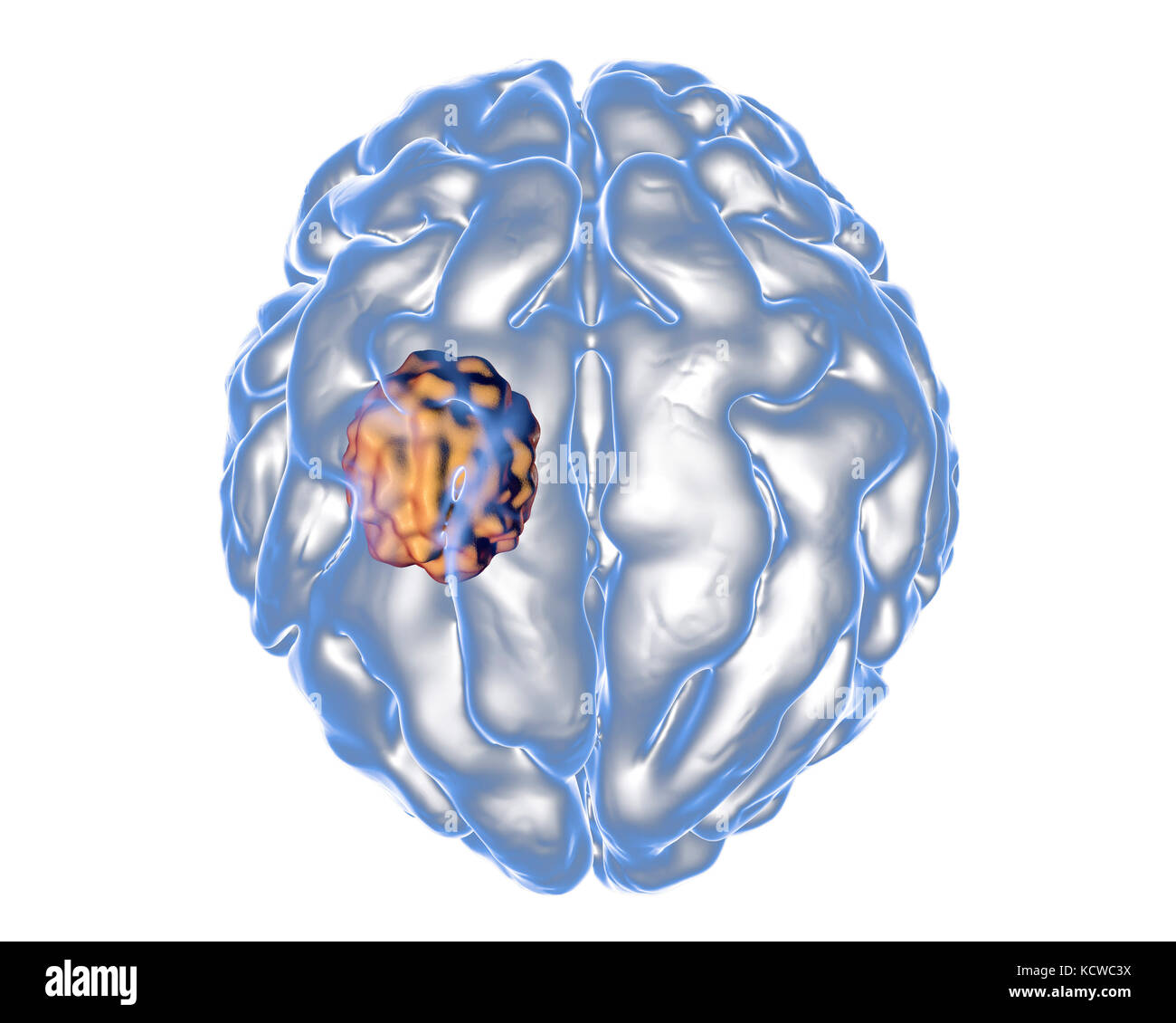 Aspergilloma du cerveau, de l'illustration. Aussi connu comme le ...