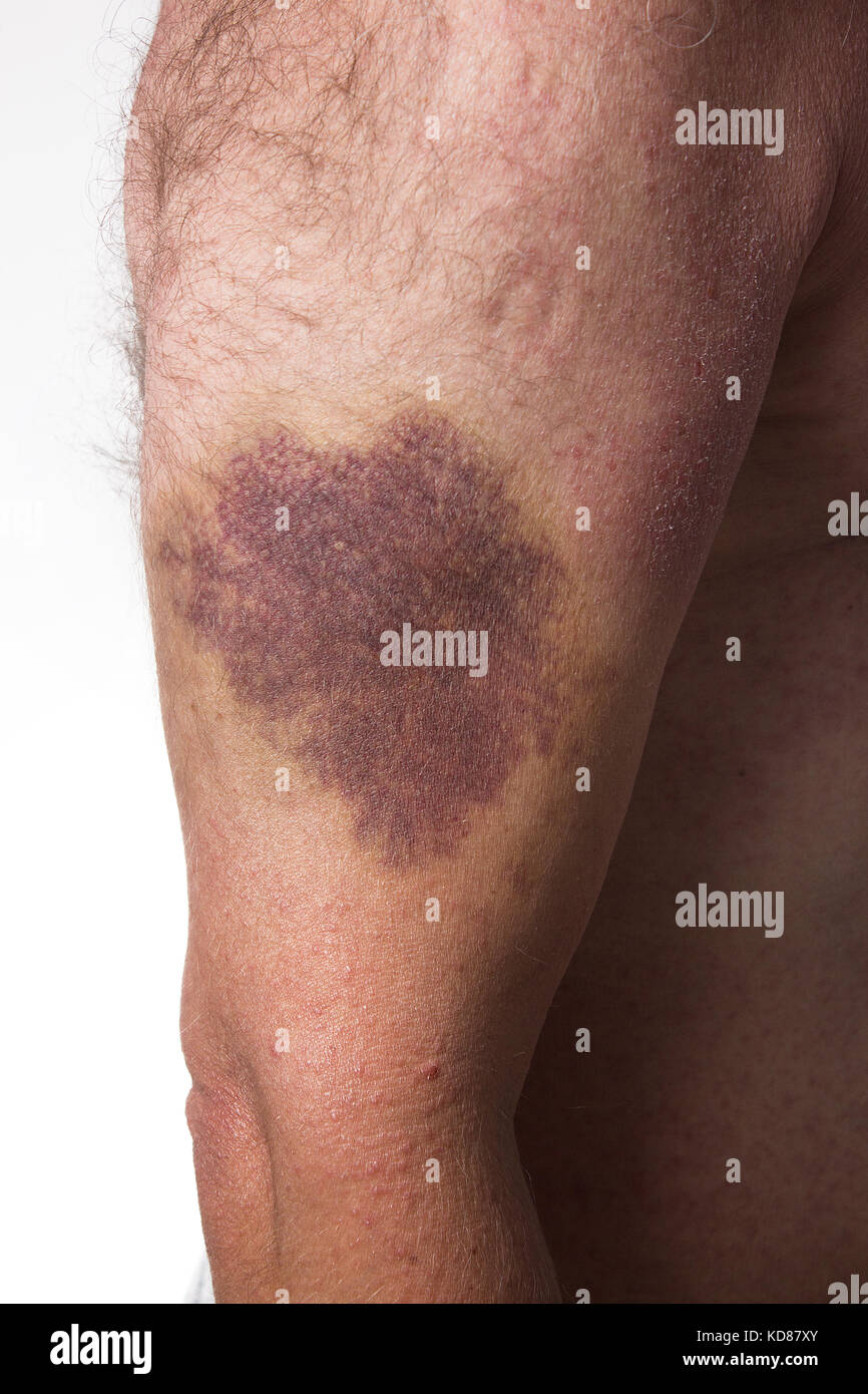 Ecchymose sur la peau Banque de photographies et d’images à haute ...