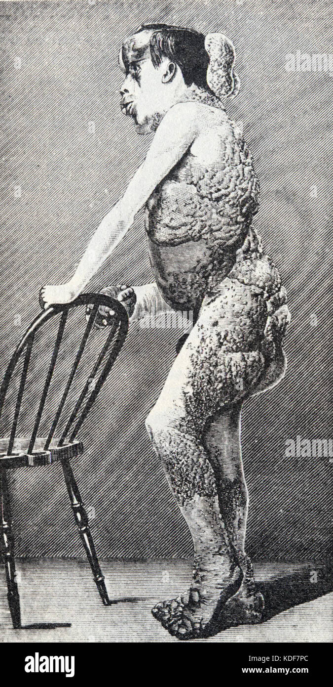 Joseph merrick Banque de photographies et d’images à haute résolution ...