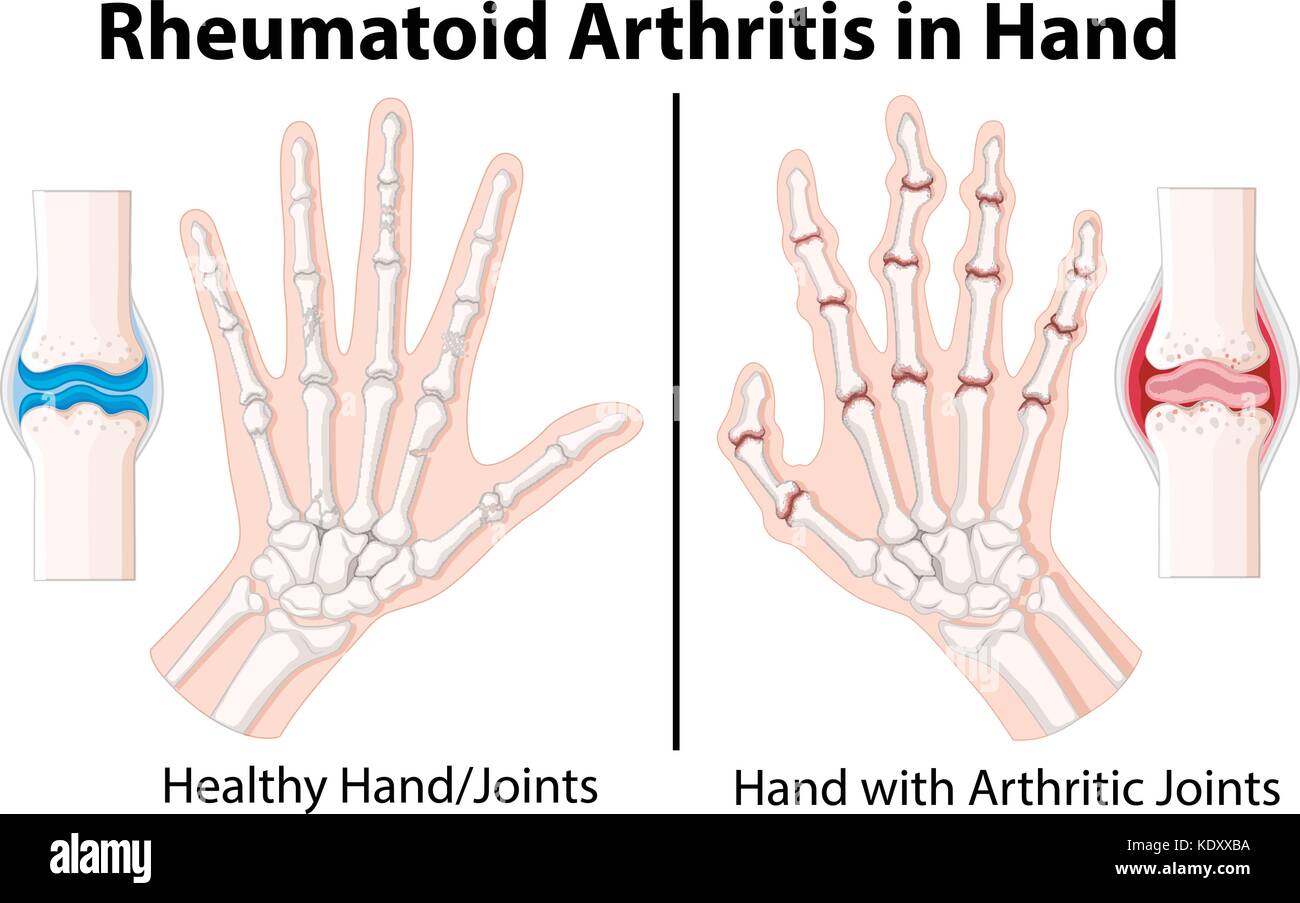 Schéma de l'arthrite rhumatoïde dans la main illustration Image ...