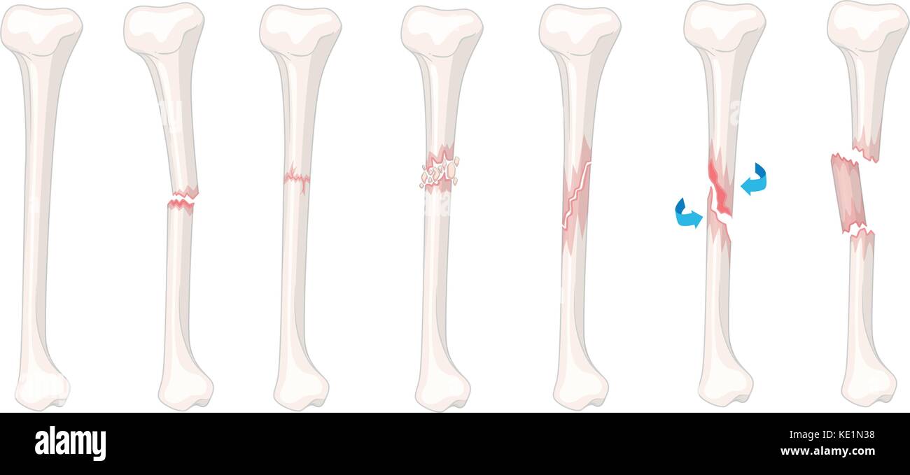 Différentes étapes de l'illustration de la fracture de jambe Image ...