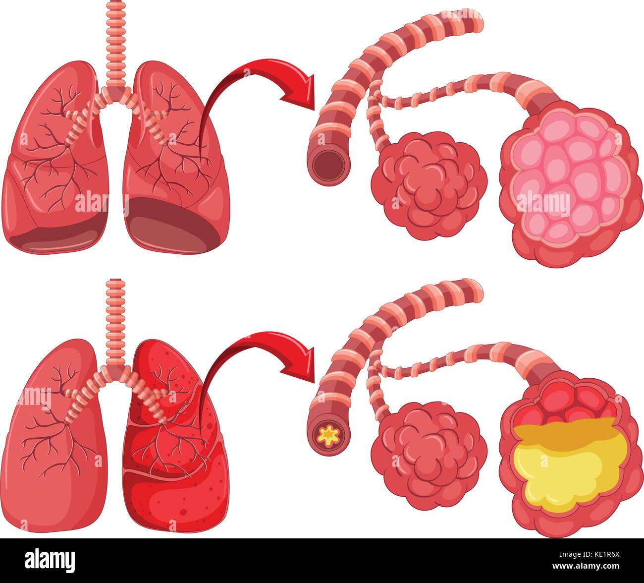 Pneumonia lung drawing Banque d'images vectorielles - Page 2 - Alamy