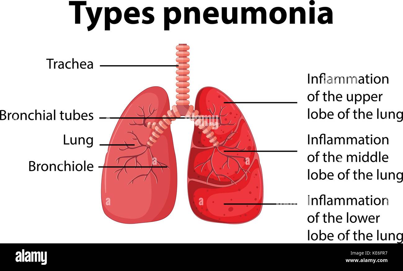 Pneumonia lung drawing Banque d'images vectorielles - Alamy