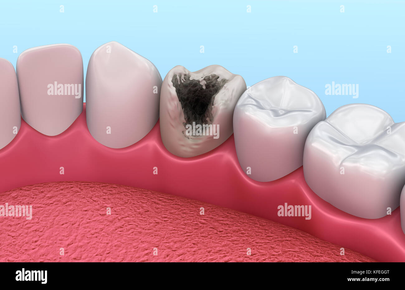 Caries illustration Banque de photographies et d’images à haute ...