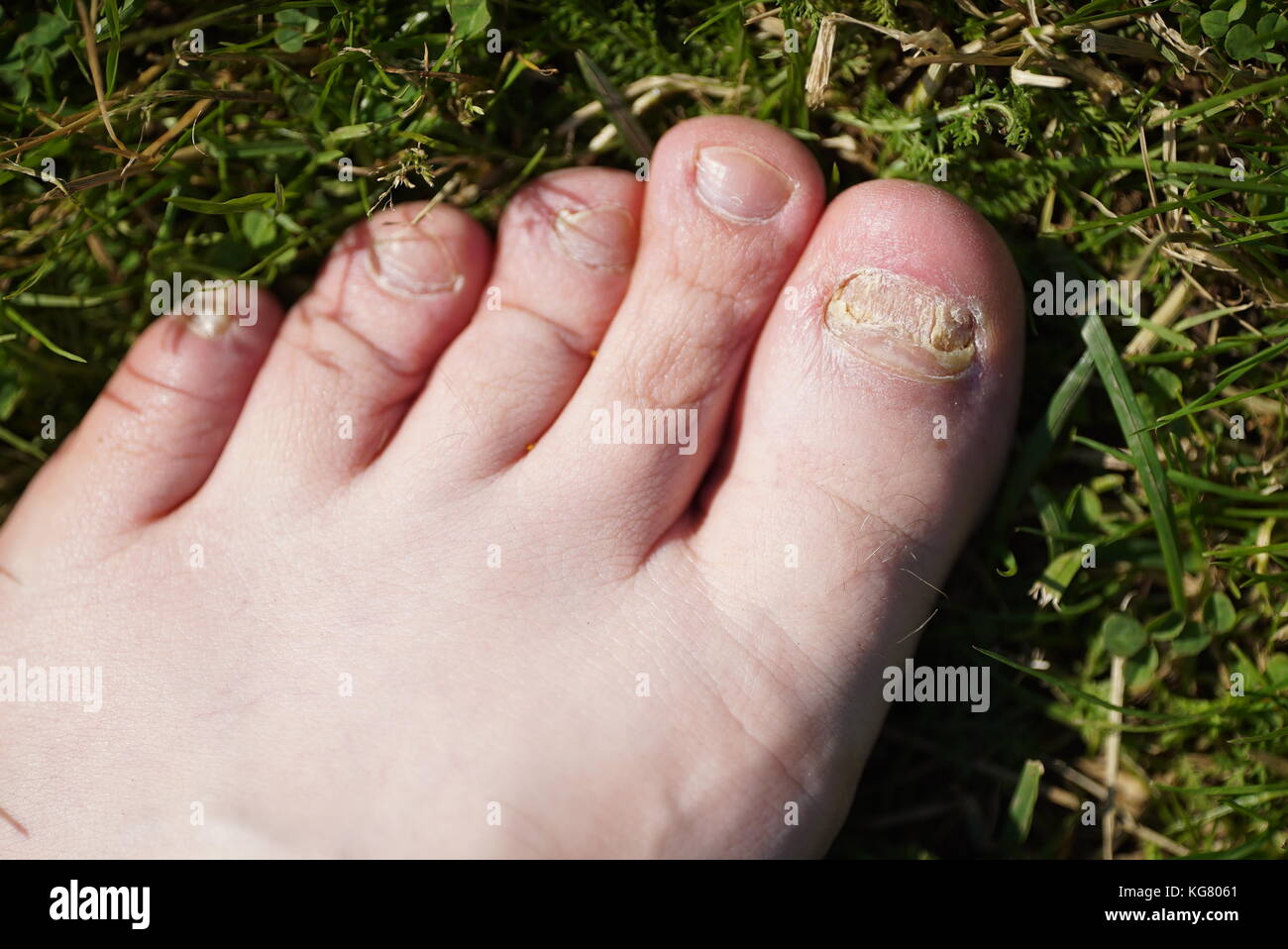 Maladie Des Ongles Fongiques Banque d'image et photos - Alamy