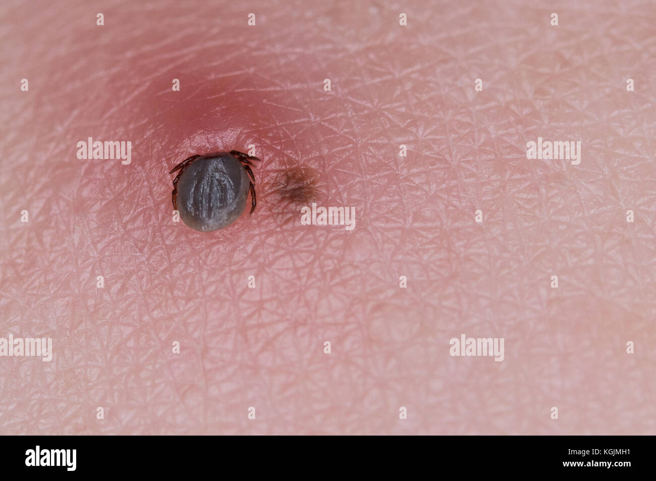 Morsure de tique Banque de photographies et d’images à haute résolution ...