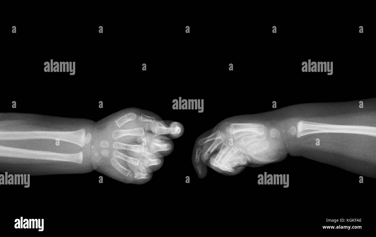 Radiographie du bras Banque de photographies et d’images à haute ...