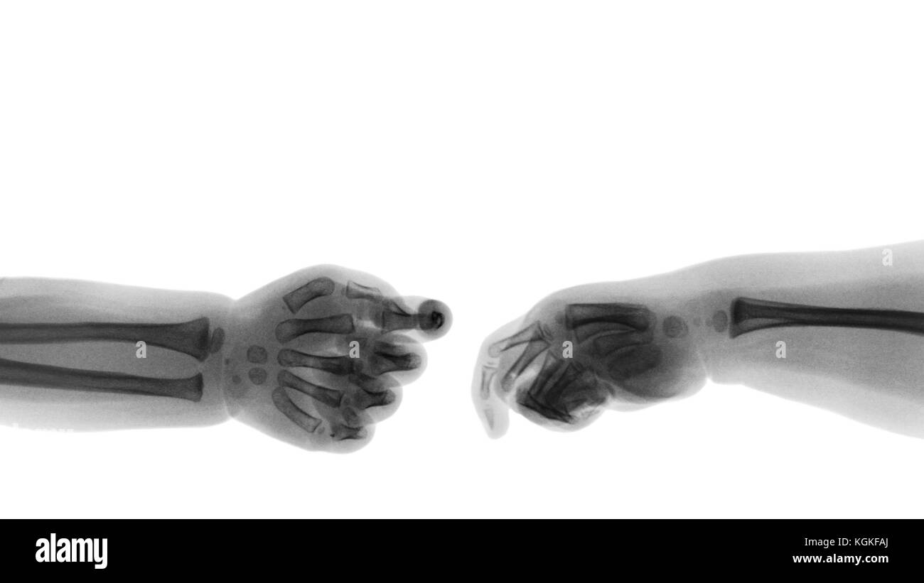 Radiographie du bras Banque de photographies et d’images à haute ...