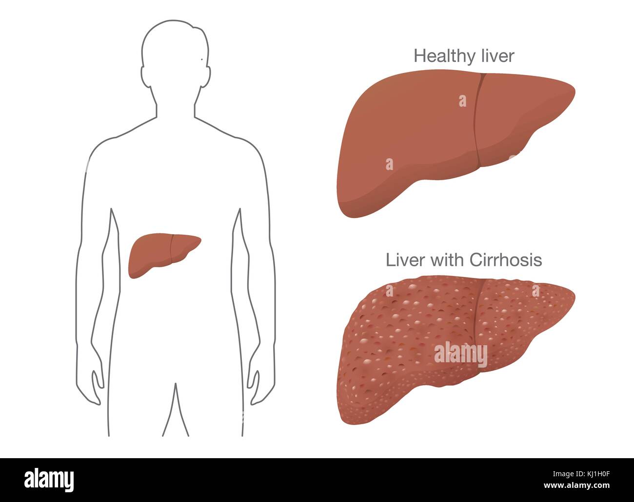 La comparaison entre la santé du foie et la cirrhose Image Vectorielle ...