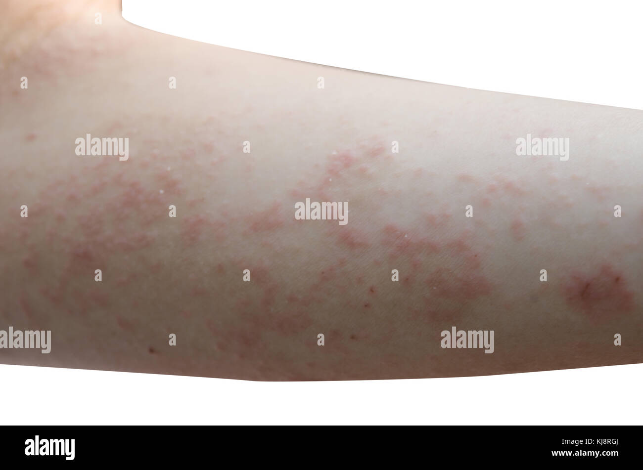Éruptions cutanées et de la peau sur les bras, isolé sur fond blanc ...
