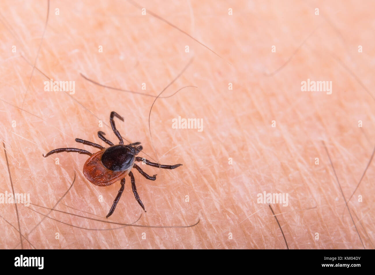 Détail de tique sur la peau humaine. Ixodes ricinus. Parasite dangereux ...