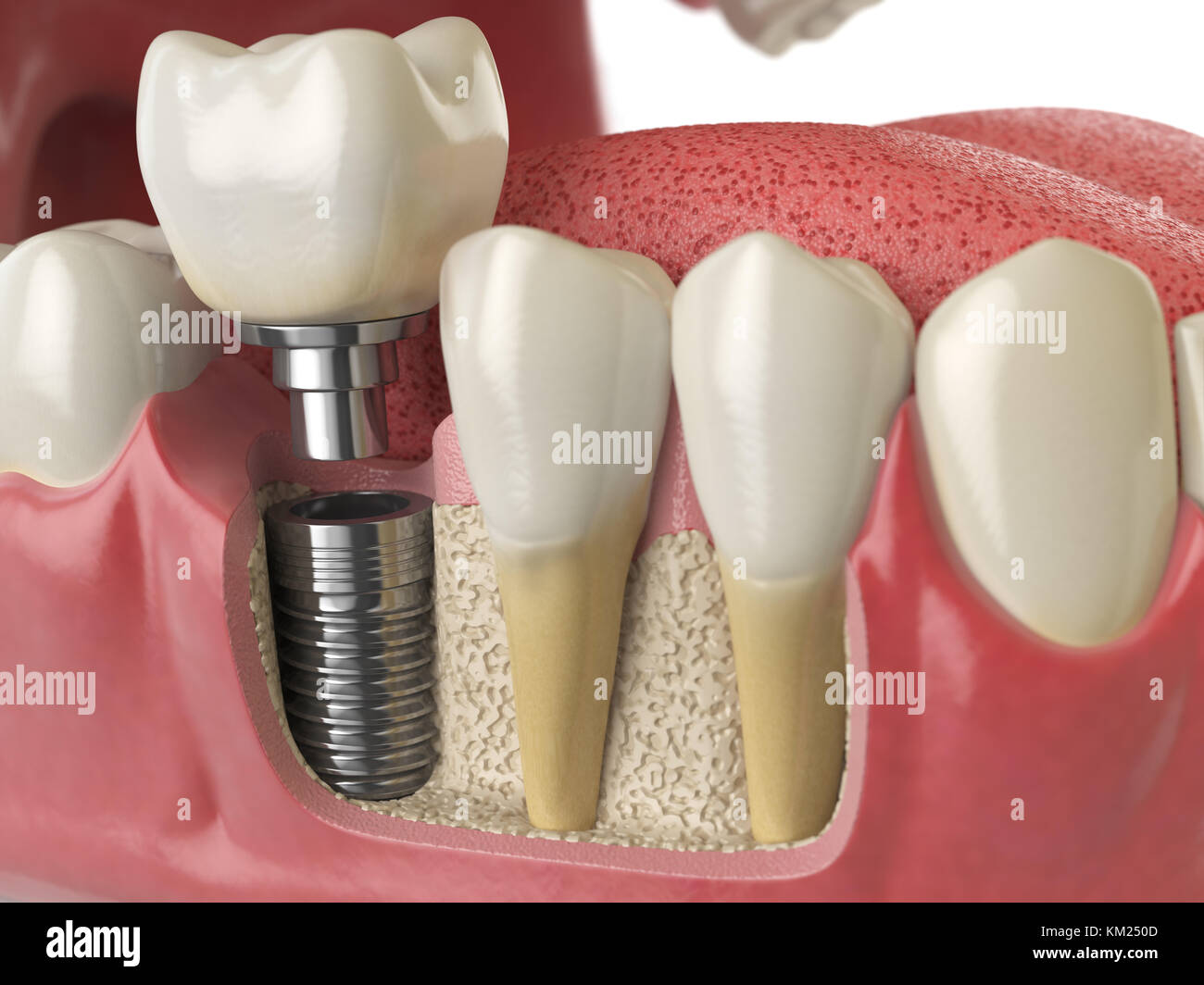 Anatomie de la santé des dents et des implants dentaires dents dentura ...
