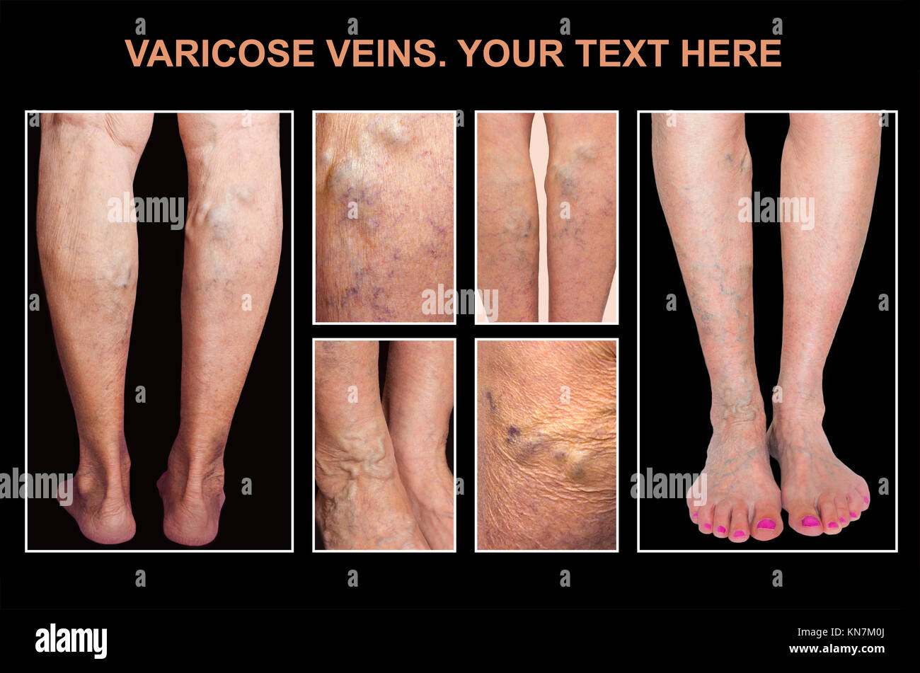 Douloureux varices, varicosités, varices, sur une jambe gravement ...
