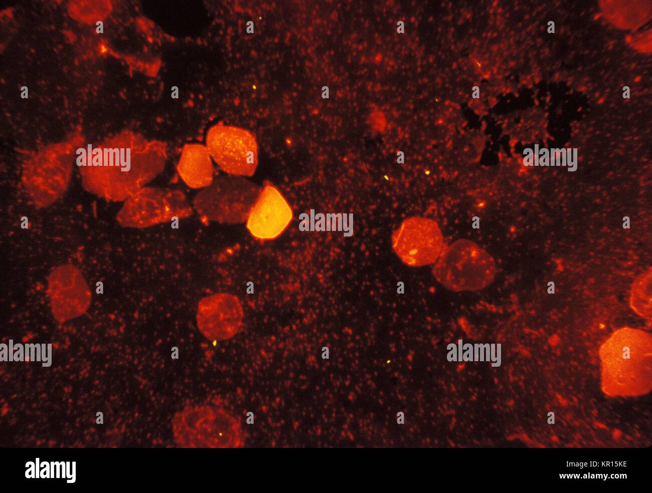 Nous voyons ici Mycobacterium tuberculosis dans un frottis d ...