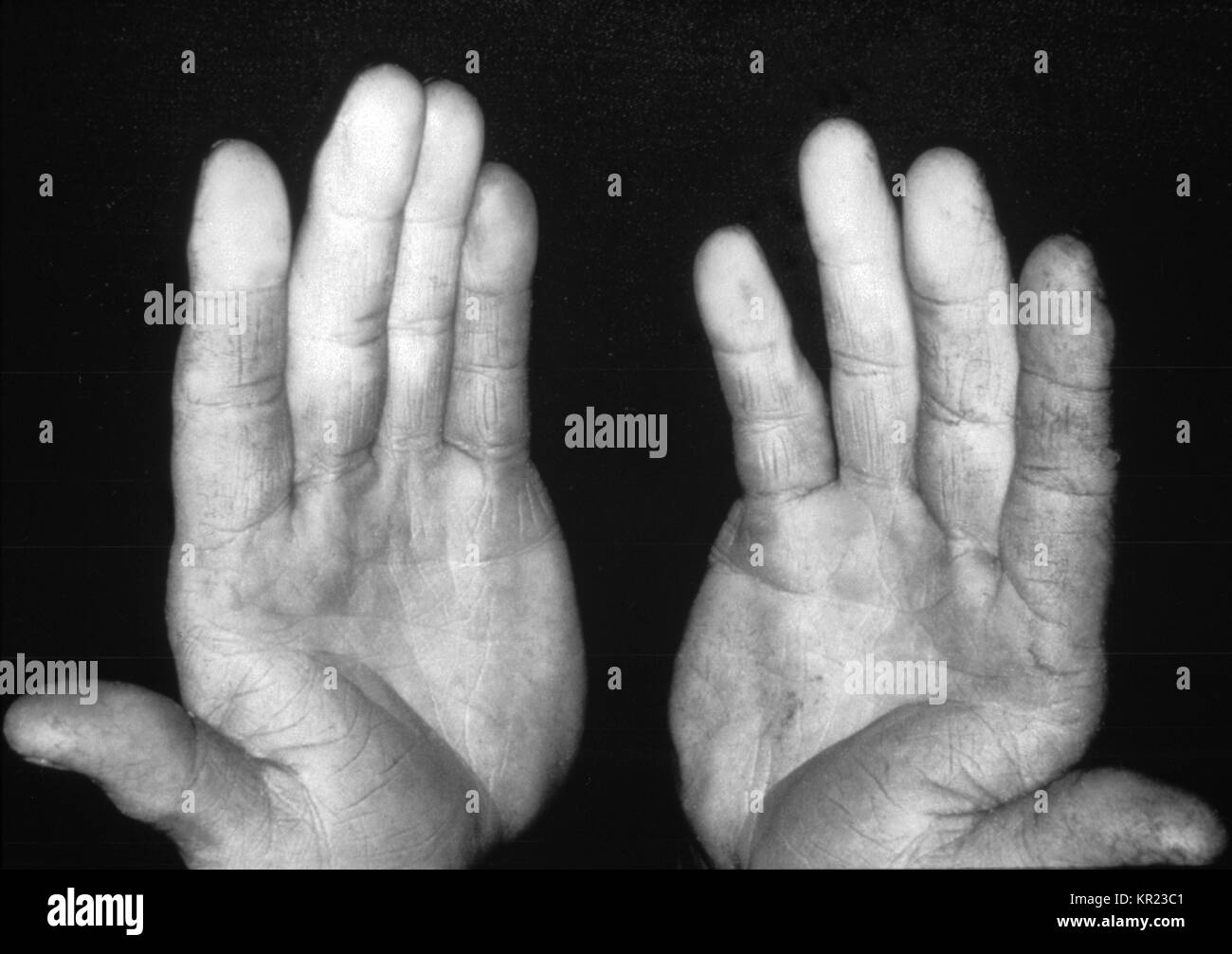Maladie de raynaud Banque d'images noir et blanc - Alamy