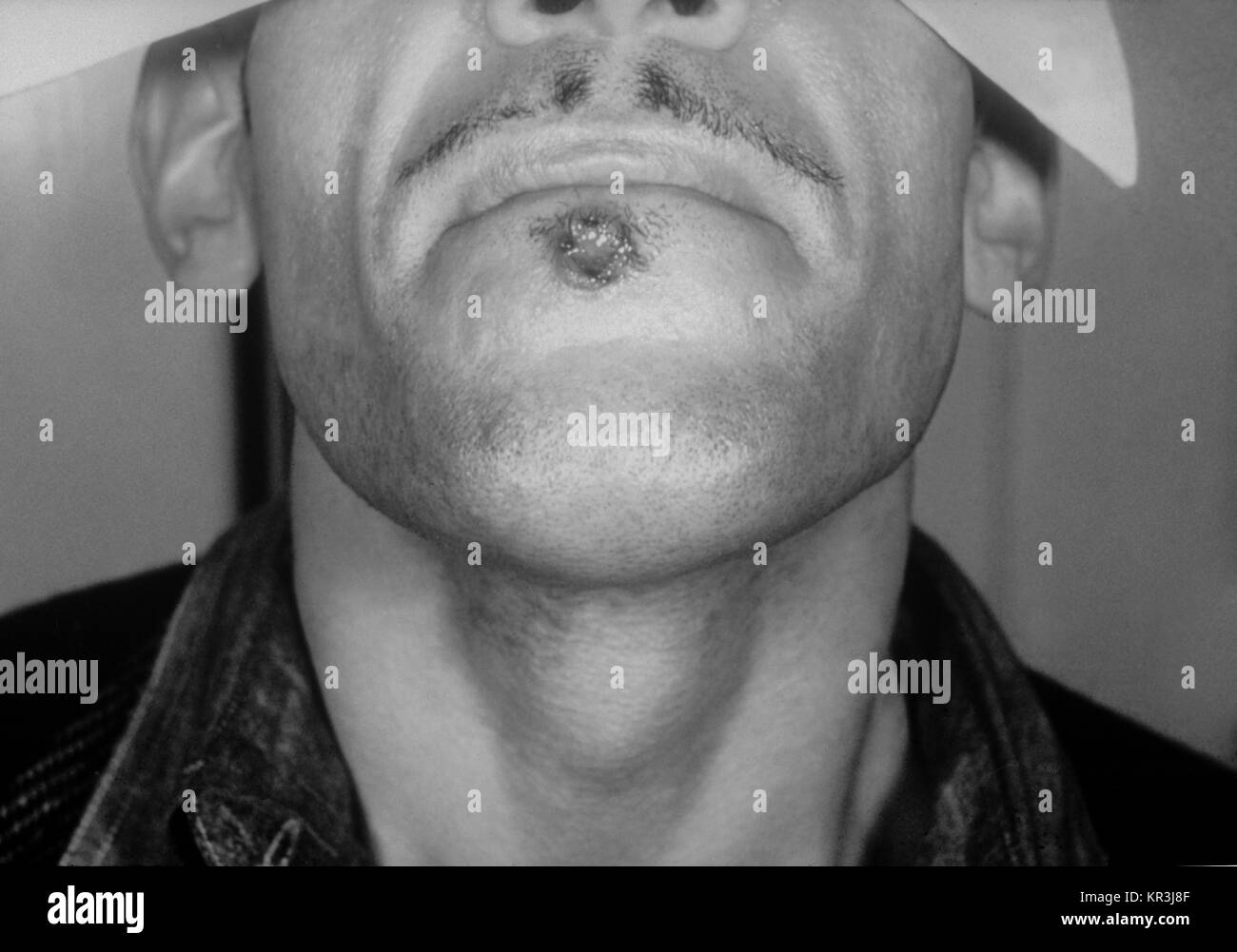 Syphilis Chancre Banque d'image et photos - Alamy