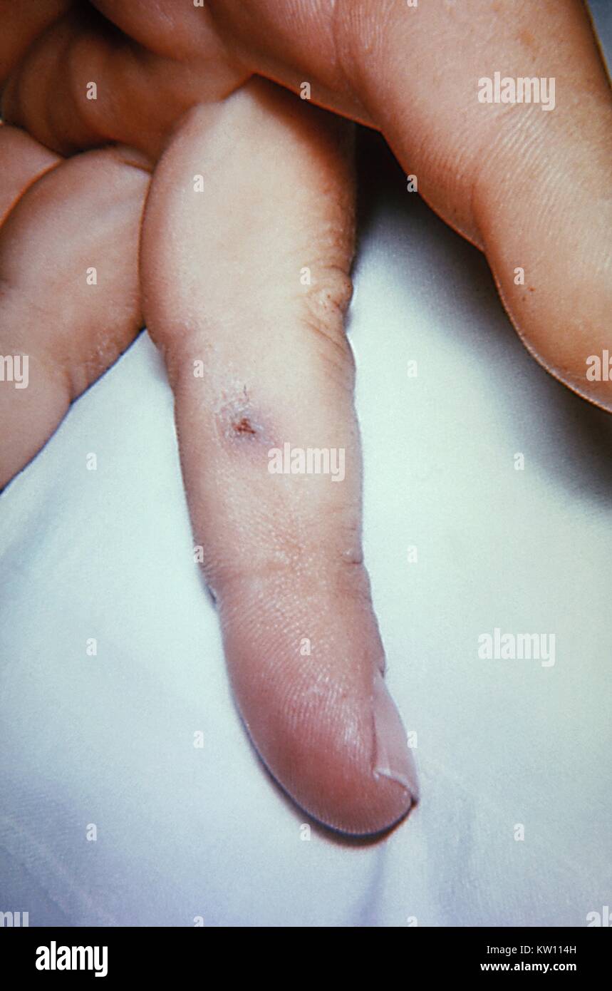 Tularemia lesion Banque de photographies et d’images à haute résolution ...