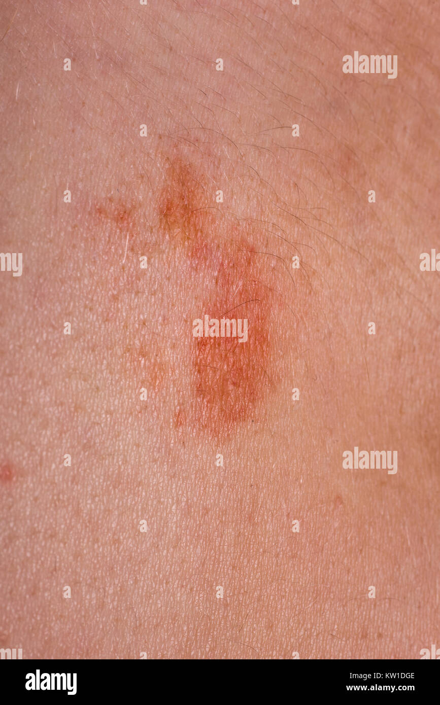 Tache Rouge Peau Banque d'image et photos - Alamy