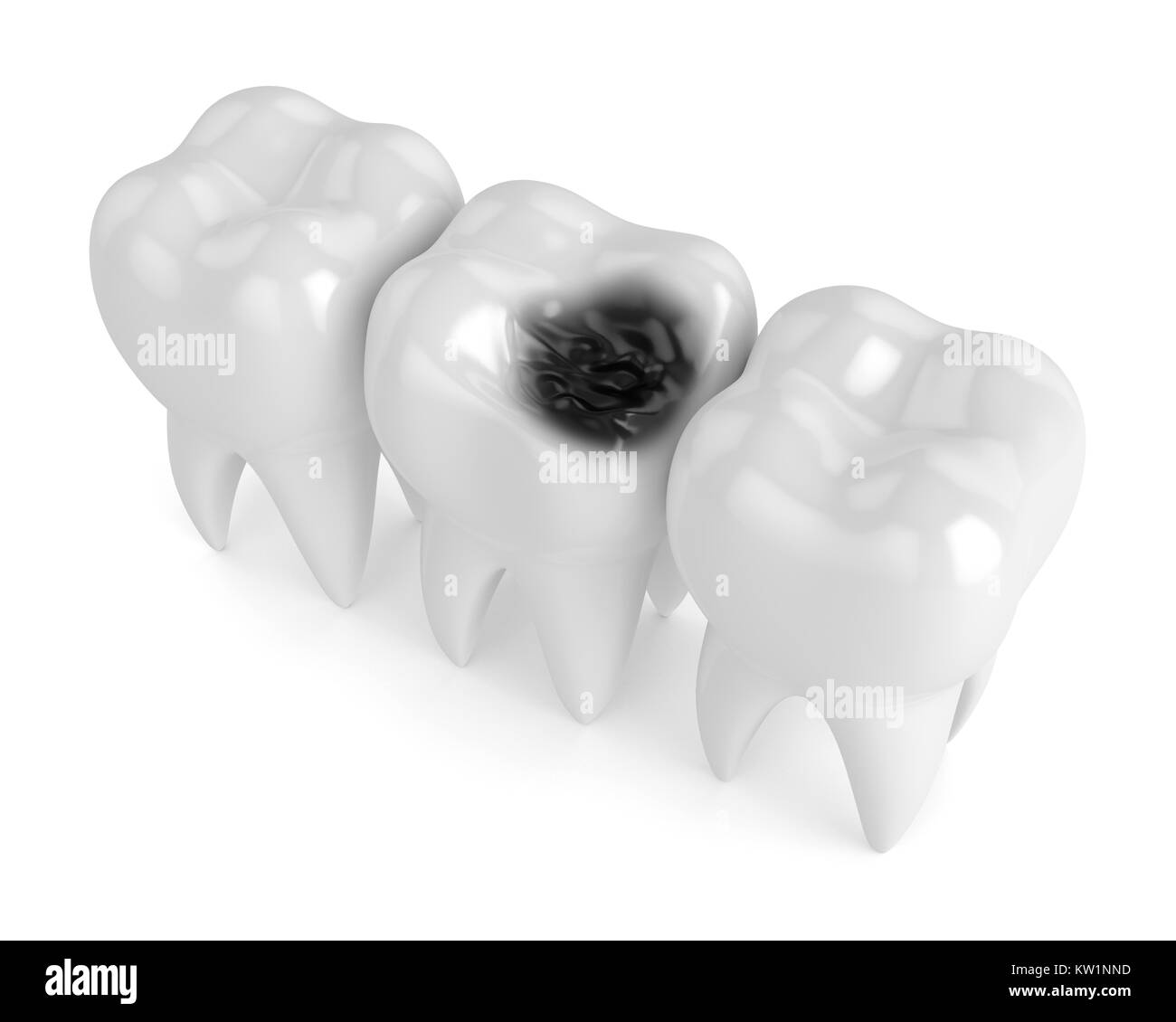 Periodontitis caries Banque d'images noir et blanc - Alamy