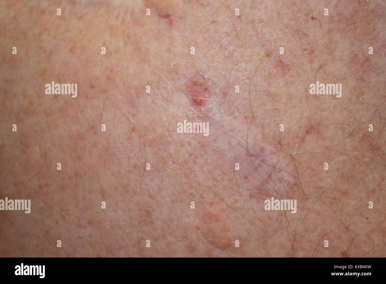 Le carcinome basocellulaire nodulaire Photo Stock - Alamy